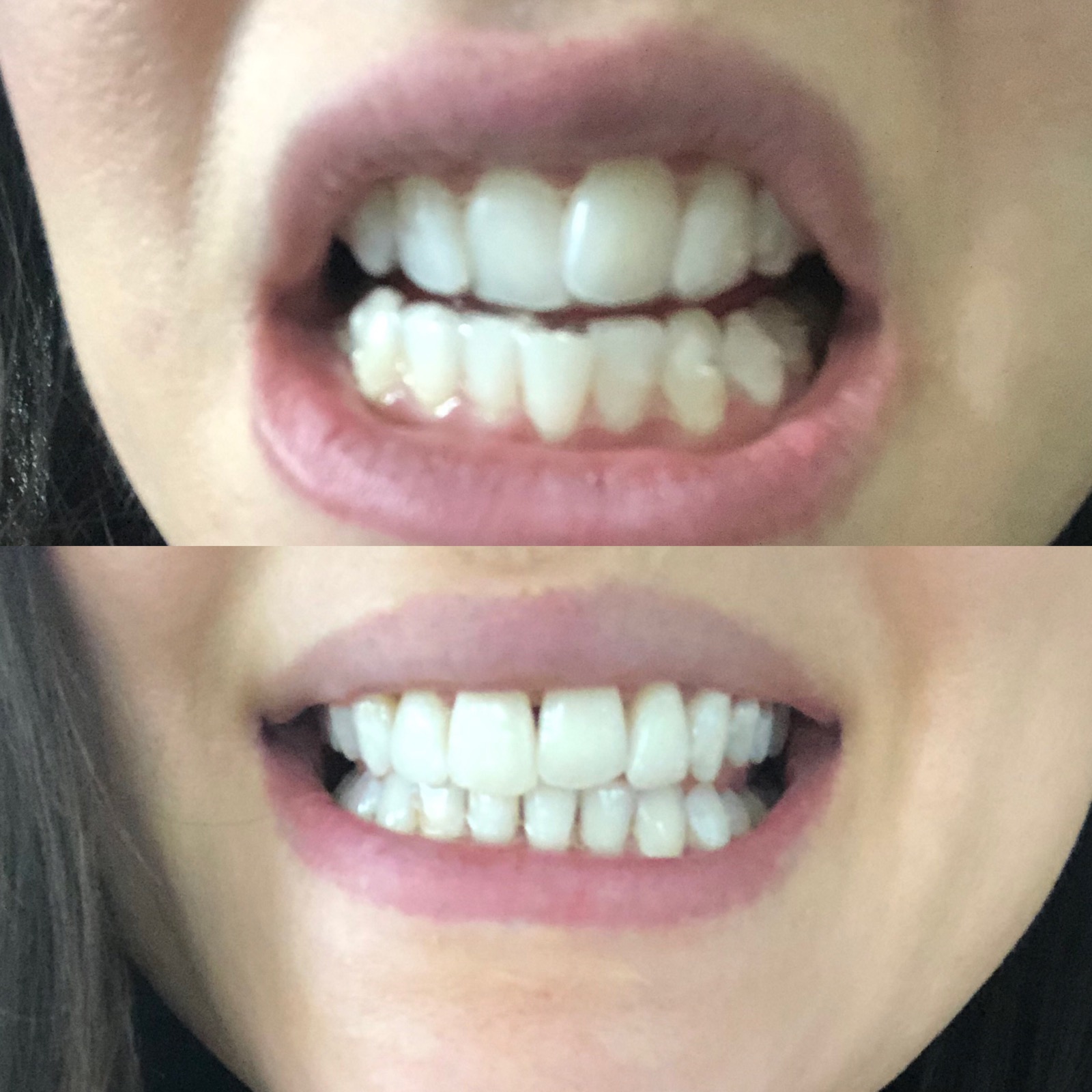 My Invisalign Treatment: Before & Afters - Veronika's Blushing