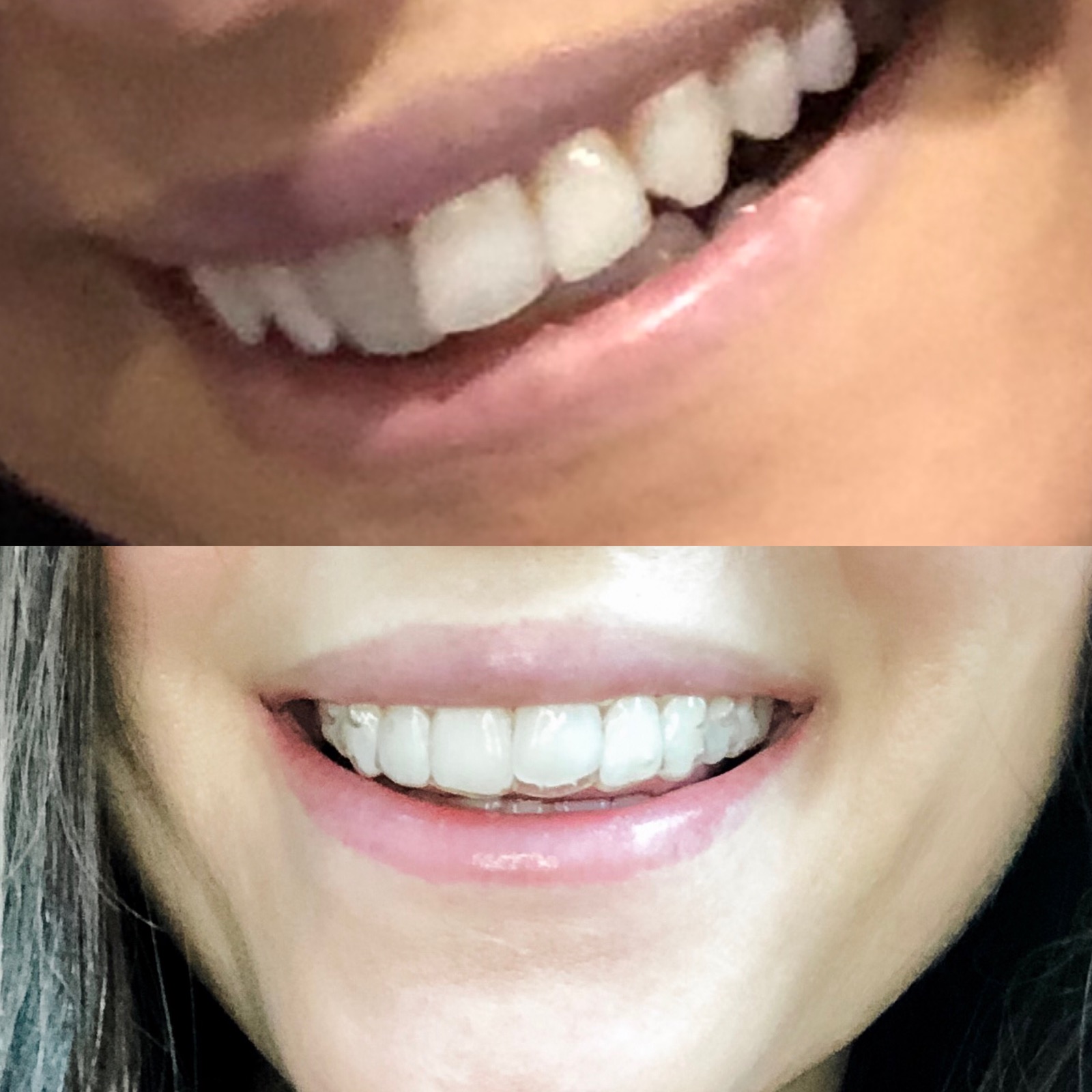 My Invisalign Treatment: Before & Afters - Veronika's Blushing