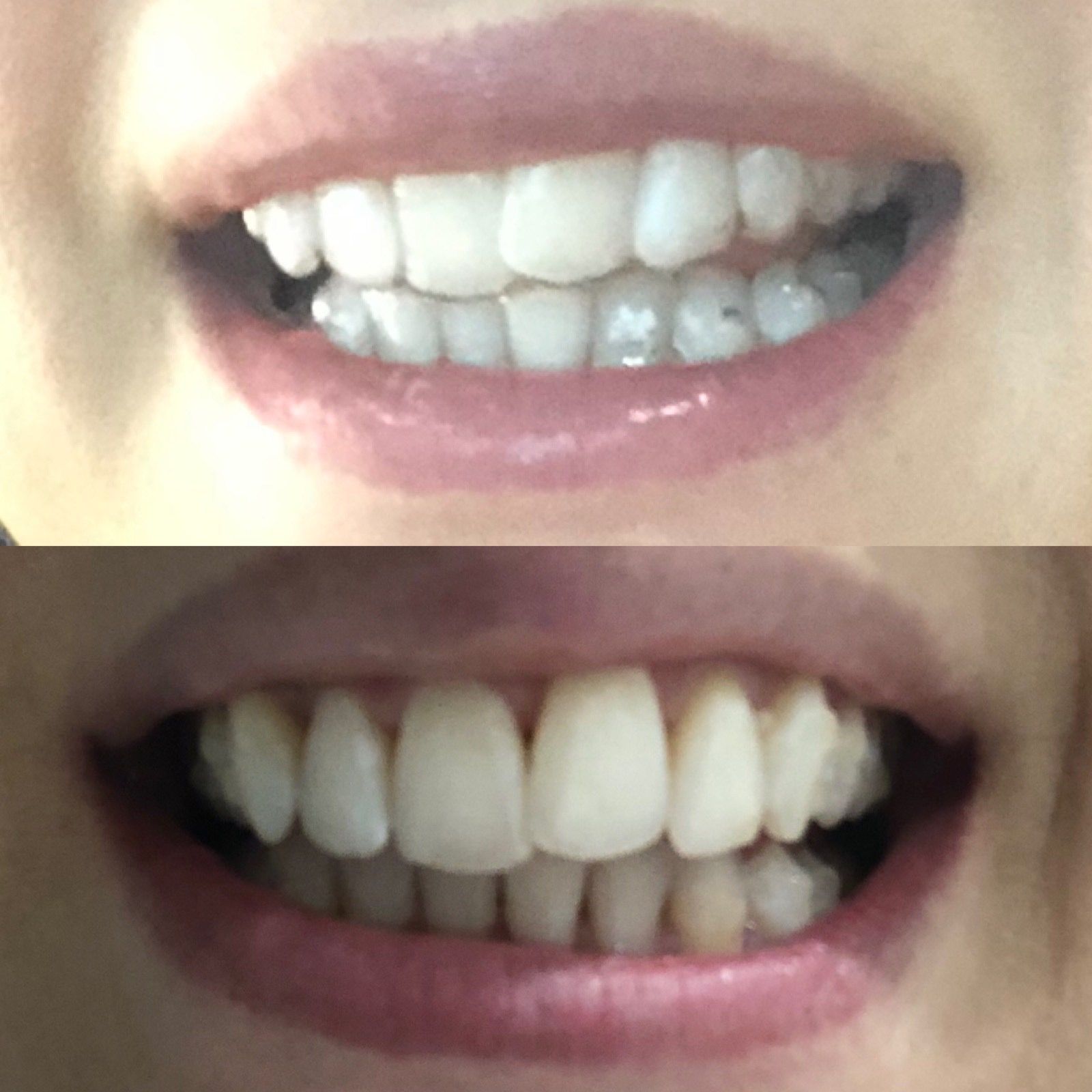 Invisalign Update & What to Expect with Invisalign Refinement Trays ...